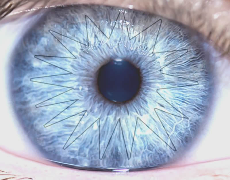 Ophthalmic Sutures - MZF4 Medical